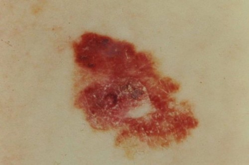 10 Deadly Signs of Skin Cancer You Need to Spot Early - Page 8 - TopManNews